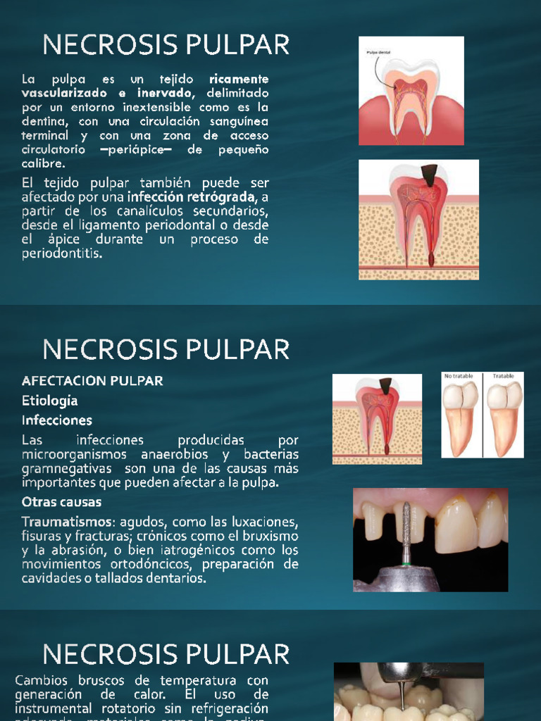 NECROSIS PULPAR | PDF