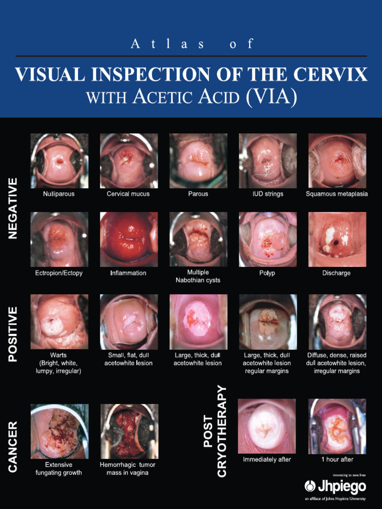 Atlas of Cervix During VIA | PDF