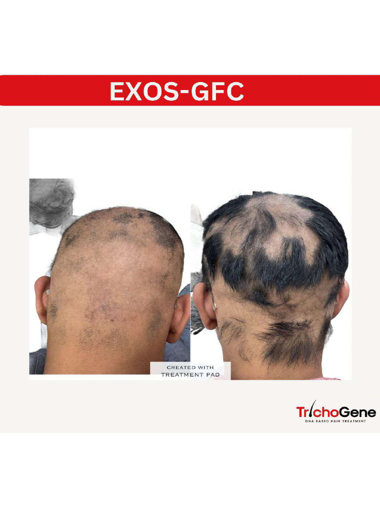 Exos Gfc Results | PDF