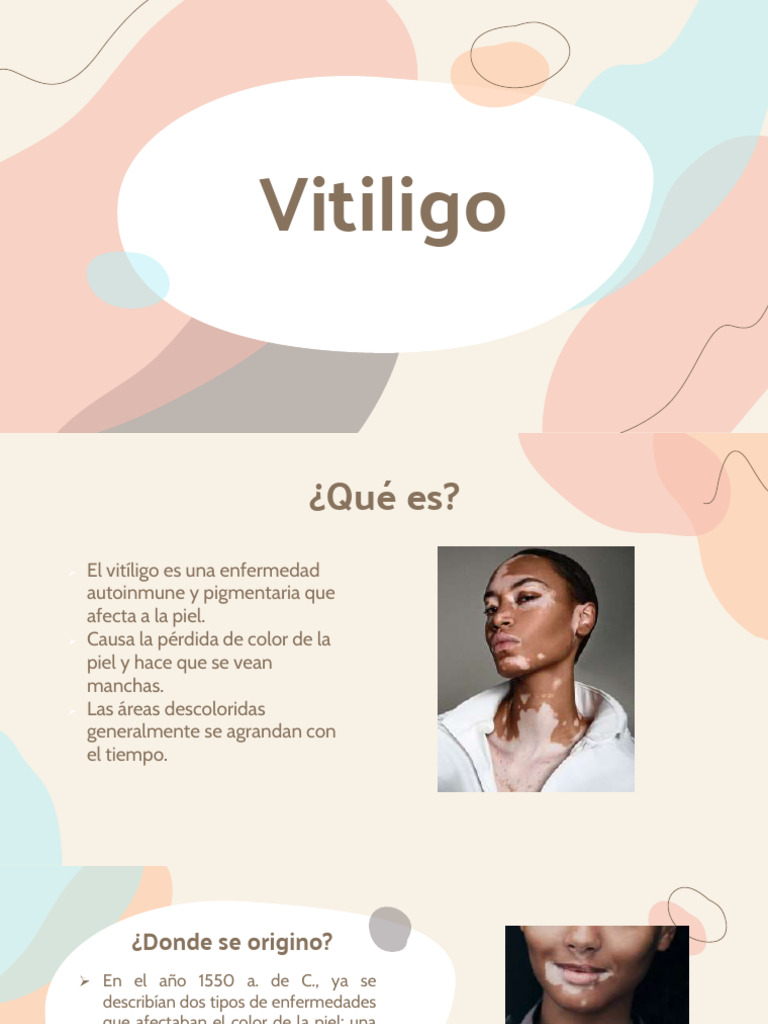 vitiligo | PDF