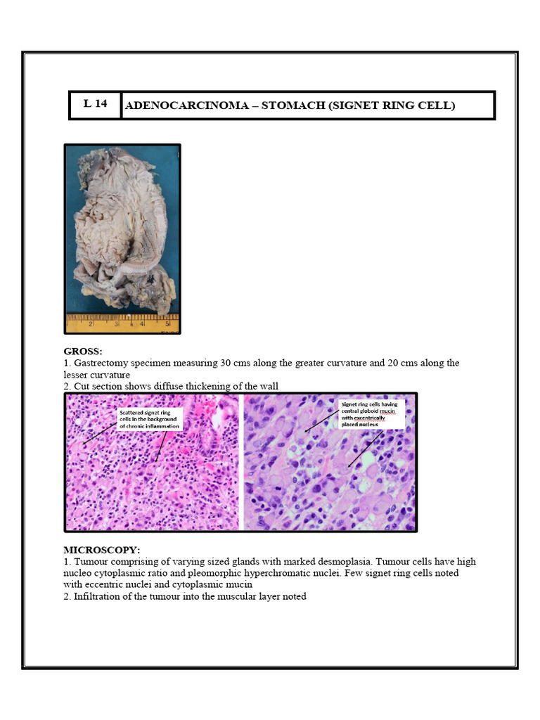 L14-Adenocarcinoma - Stomach (Signet Ring Cell) | PDF