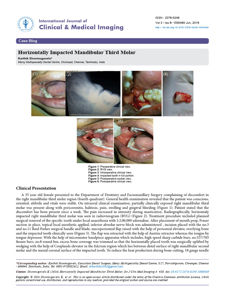 Horizontally Impacted Mandibular Third Molar | PDF | Surgery | Medical ...