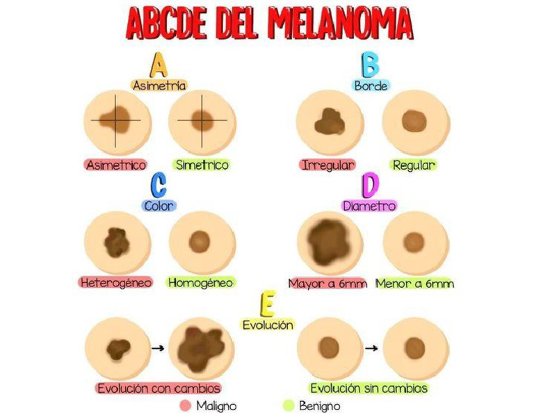 ABCDE Del Melanoma | PDF