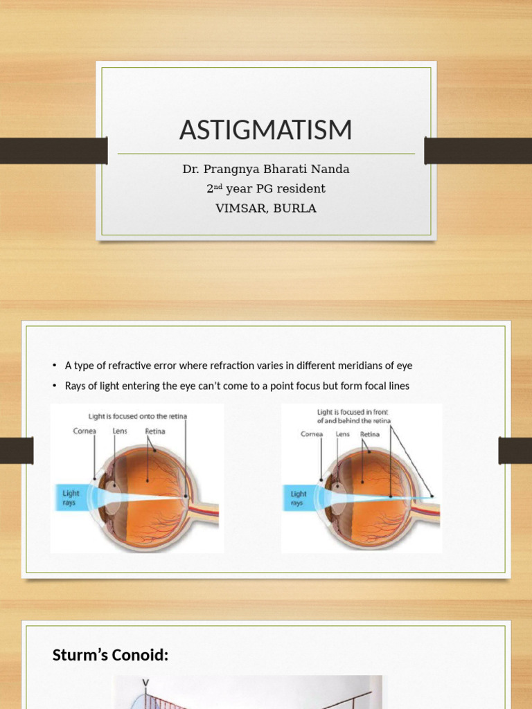 Understanding With-the-Rule Astigmatism | PDF | Contact Lens | Cornea