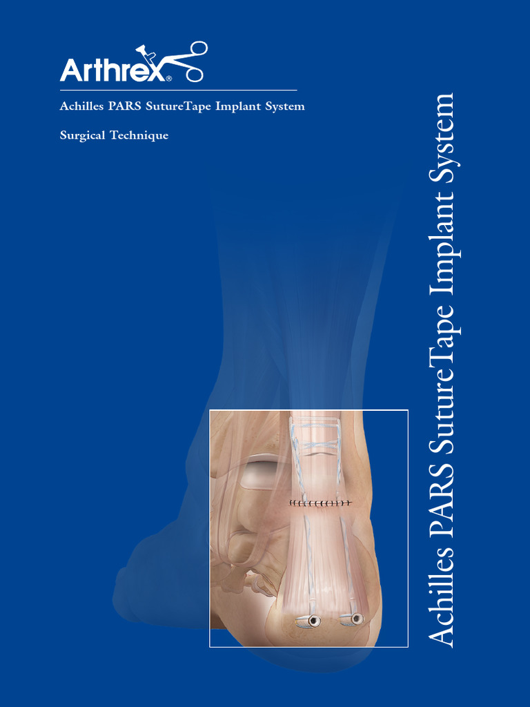 Achilles PARS SutureTape Technique Guide | PDF | Surgical Suture | Surgery