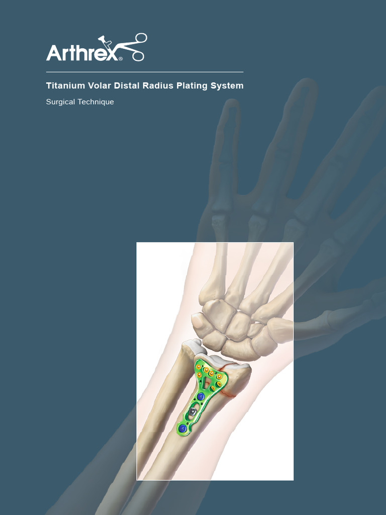 Titanium Volar Distal Radius Plating System | PDF | Drill | Limbs (Anatomy)