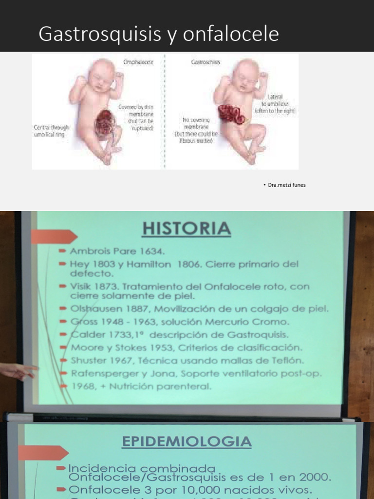 T21 - onfalocele y gastrosquisis | PDF