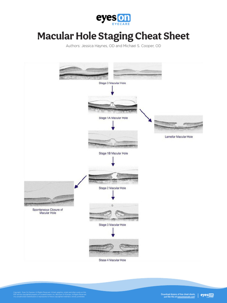 Haynes-Macular Hole Staging - Cheat-Sheet | PDF | Retina | Visual System