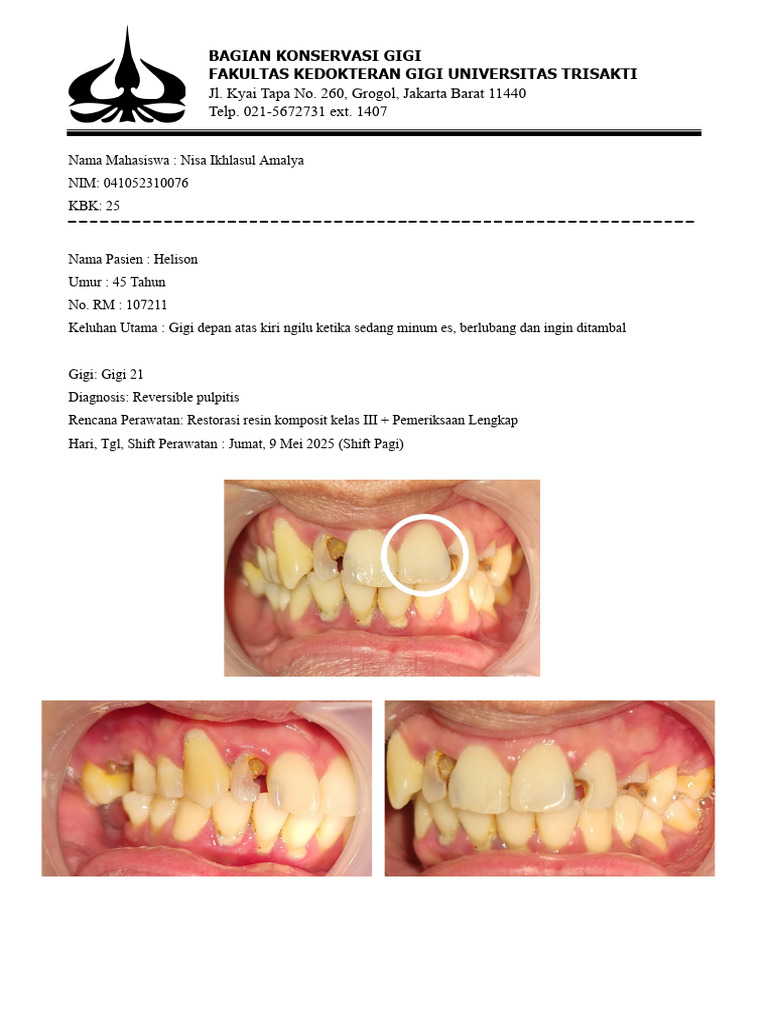 Indikasi Restorasi Resin Komposit Kelas III+PL+TPC_Nisa Ikhlasul Amalya_041052310076 | PDF