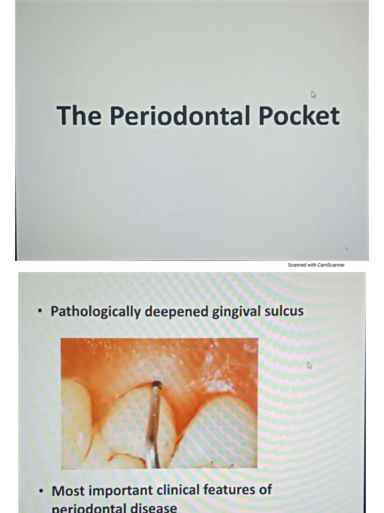 Periodontal Pocket | PDF