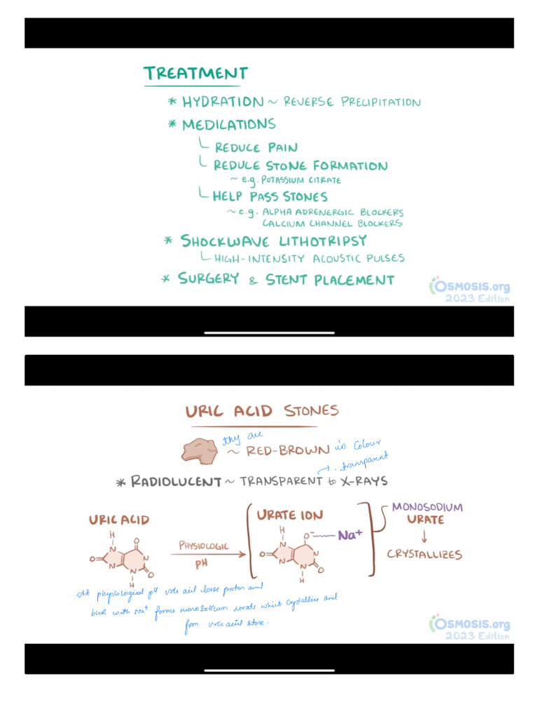Nephrolithias | PDF