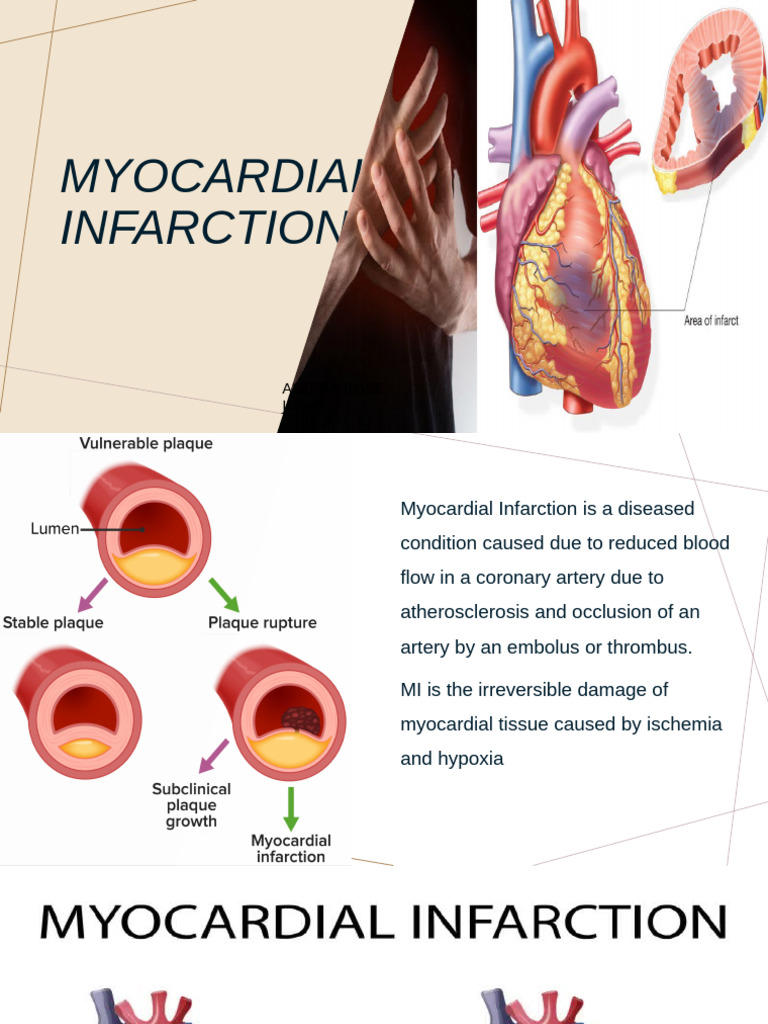 Myocardial Infarction | PDF | Myocardial Infarction | Ischemia