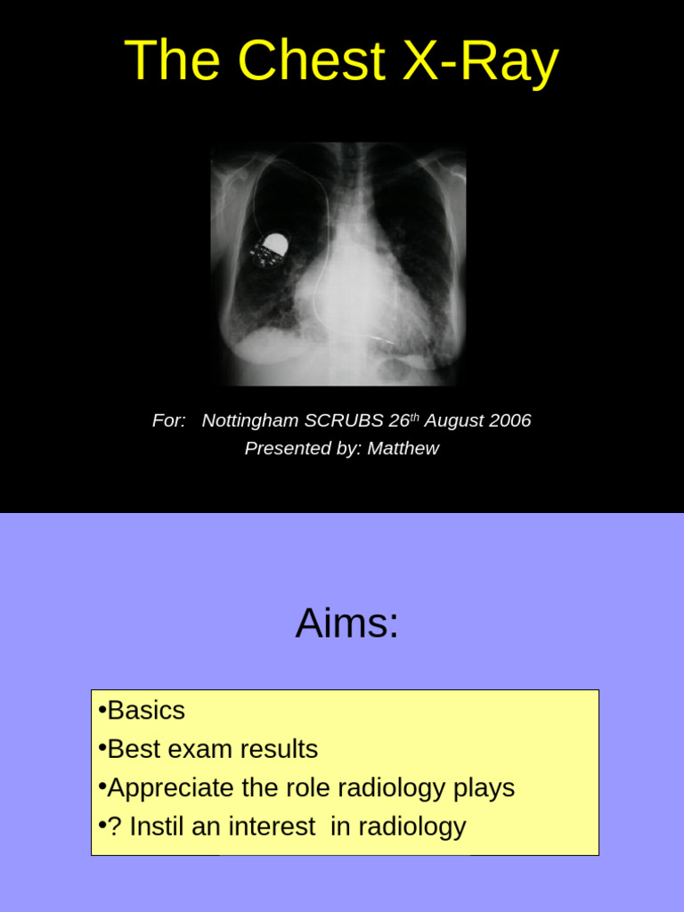 Chest X-Ray Basics and Interpretation | PDF | Lung | Medical Specialties