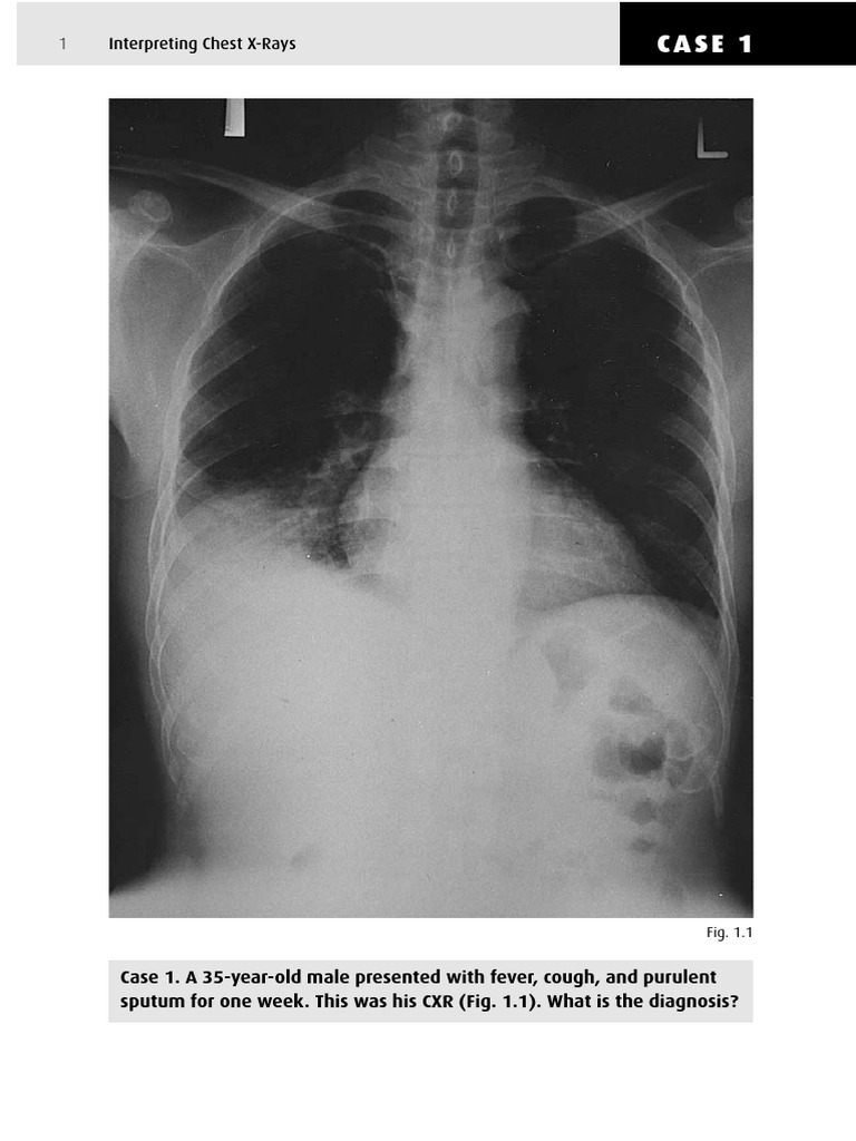 Interpreting Chest X-Rays Illustrated With 100 Cases (Philip Eng, Foong ...