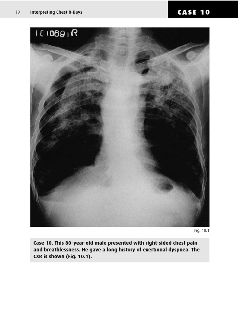 Interpreting Chest X-Rays Illustrated With 100 Cases 2 | PDF