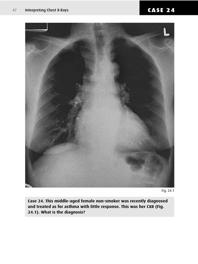 Chest X-Ray Diagnosis: Tracheal Tumor | PDF