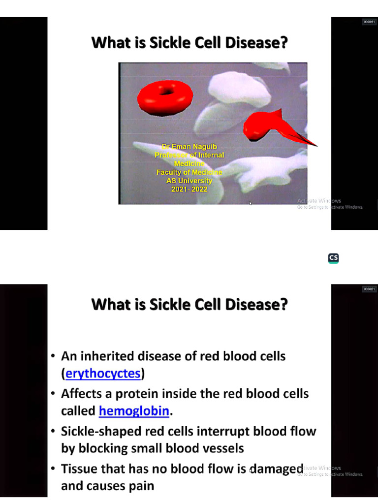 sickle cell anemia | PDF