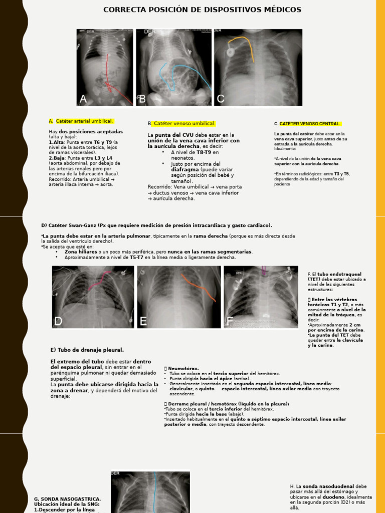 Dos Posiciones Aceptadas 1.alta T6 y T9: Punta Del CVU Unión de La Vena Cava Inferior Con La ...