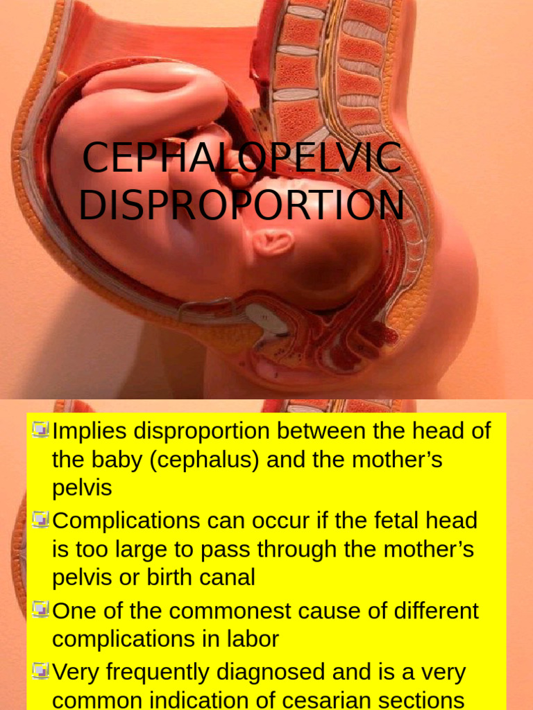 Cephalopelvic Disproportion Ok 1 | PDF