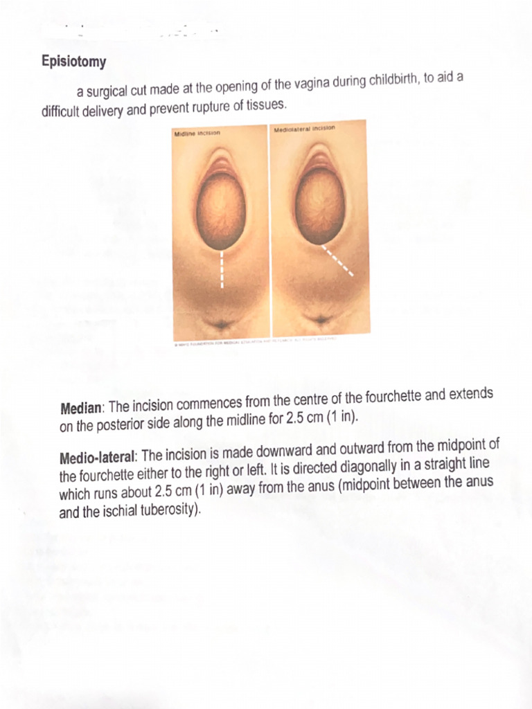 Episiotomy-final-Obstetrics | PDF