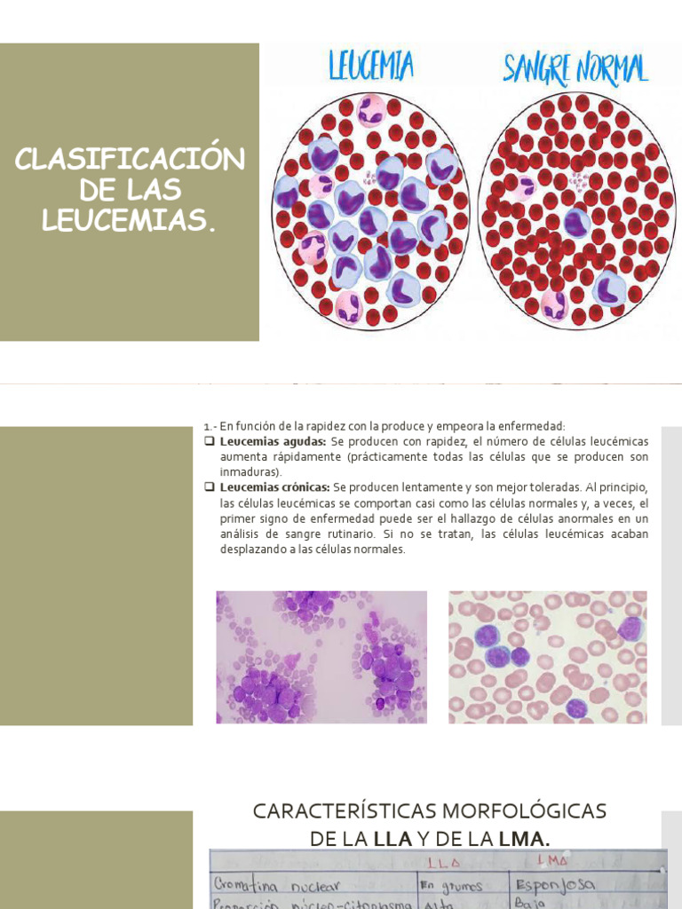 CLASIFICACIÓN DE LAS LEUCEMIAS | PDF | Leucemia | Nucleo celular