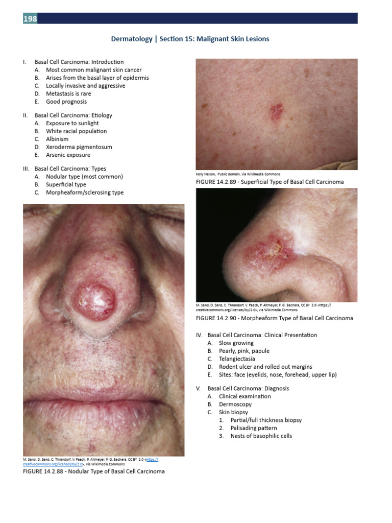Section 15 - Malignant Skin Lesions | PDF | Melanoma | Skin Cancer