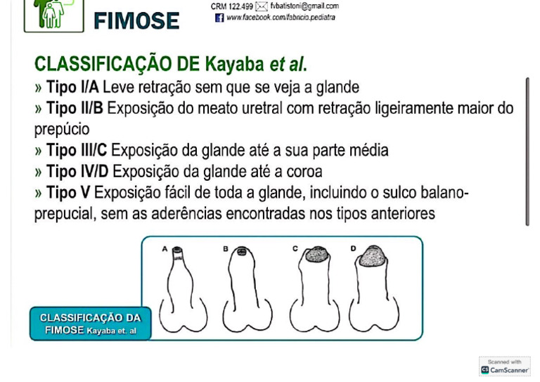 Classificações de Kayaba - Fimose | PDF