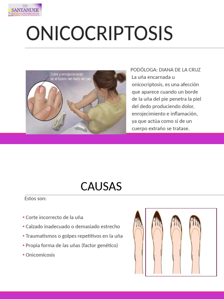 Onicocriptosis 2 | PDF | Clavo (anatomía) | Anestesia
