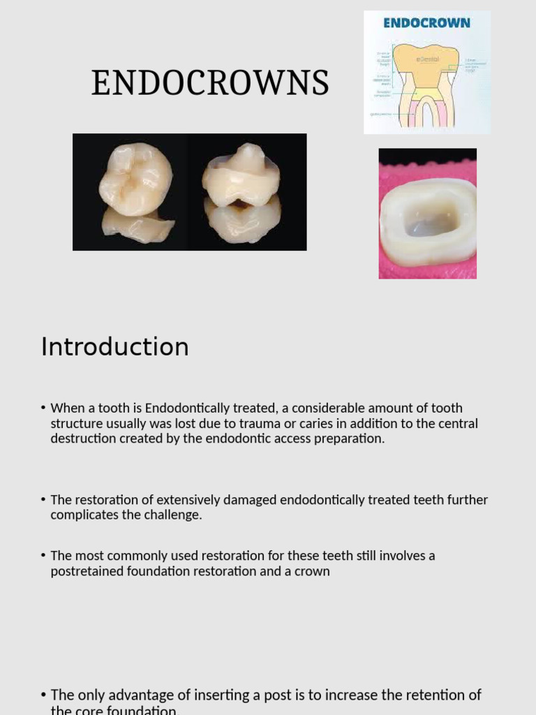 Endocrowns The Prosthodontic Way | PDF | Tooth Enamel | Dentistry