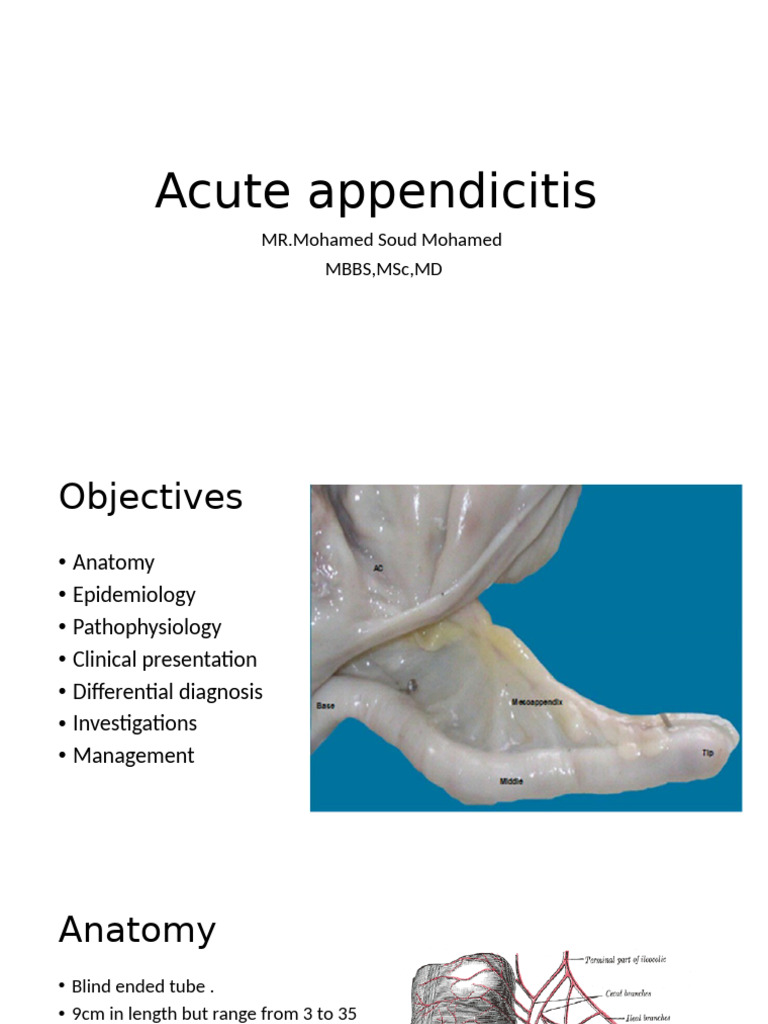Acute Appendicitis 1 | PDF