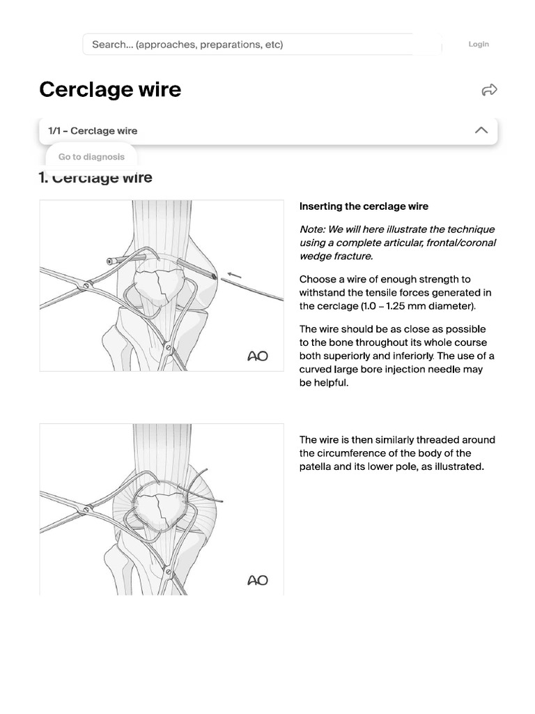Cerclage Wire AO | PDF