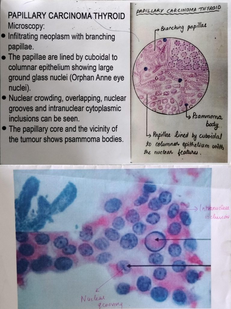 Pappillary Ca Thyroid, Adenoma Thyroid, MNG, Hashimotos Thyroiditis | PDF