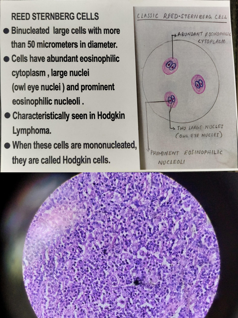 Hodgkins Lymphoma | PDF