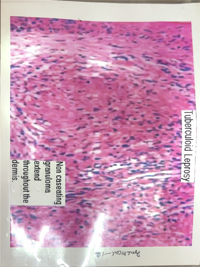 Chronic Infla+ Granuloma | PDF