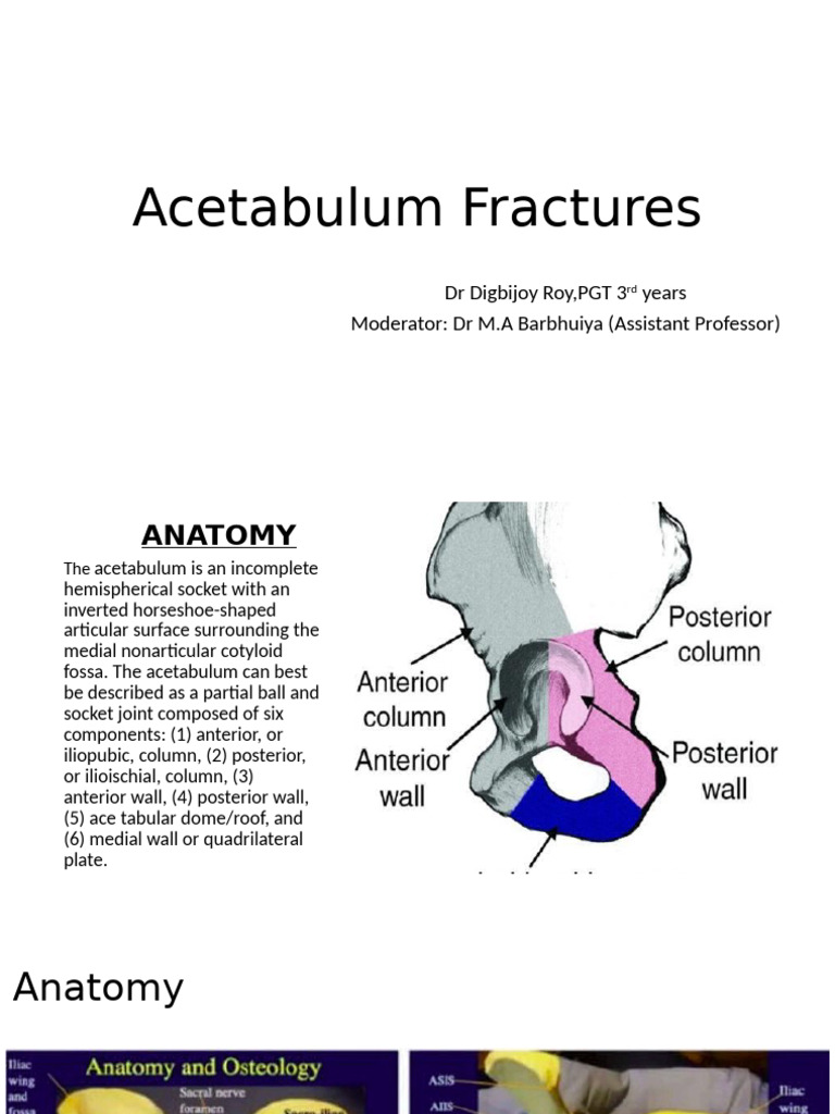 Acetabulum Fracture | PDF | Pelvis | Anatomical Terms Of Location