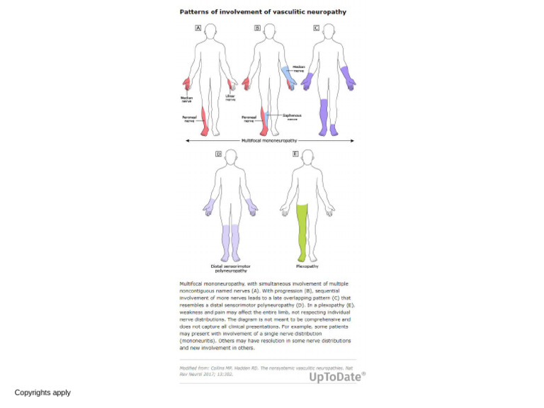 Patterns of Vasculitic Neuropathy | PDF