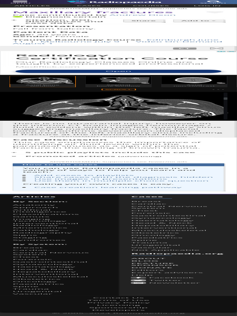 Maxillary fractures Radiology Case Radiopaedia.org | PDF | Radiology ...