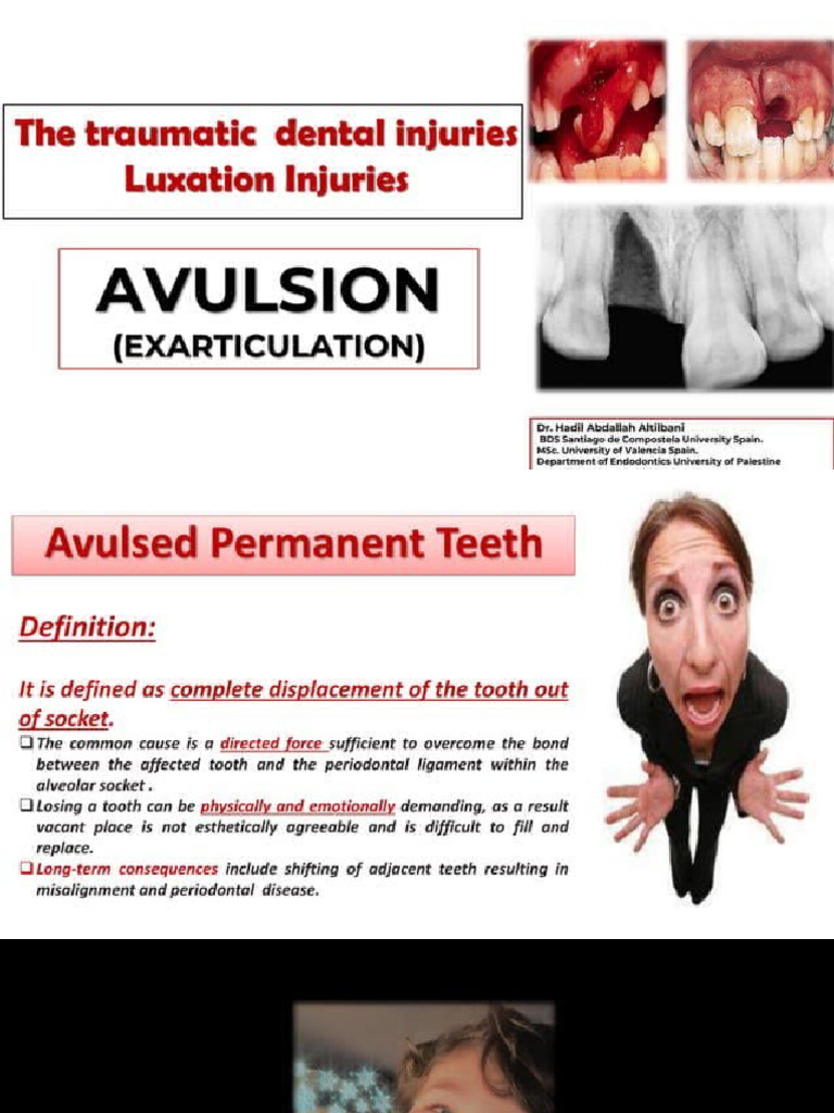 Tooth Avulsionpdf | PDF