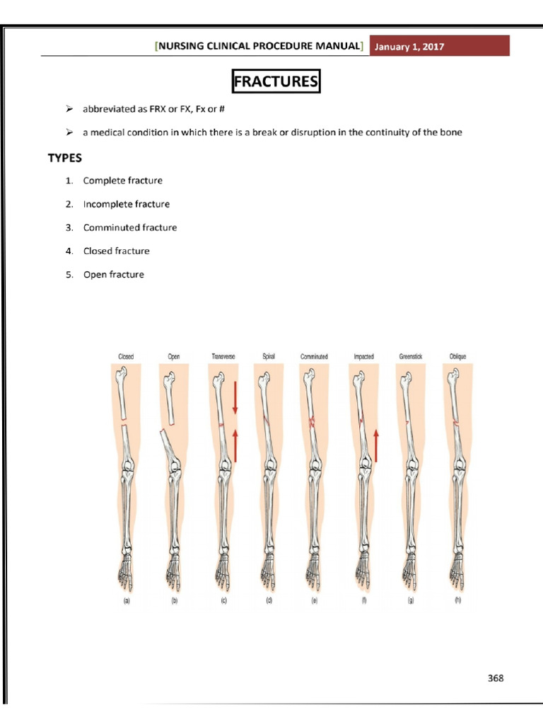 Management of Fractures | PDF