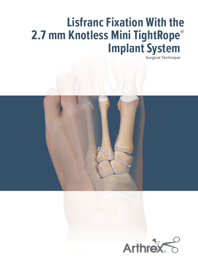 Lisfranc Fixation With The 27 MM Knotless Mini Tightrope Implant System ...