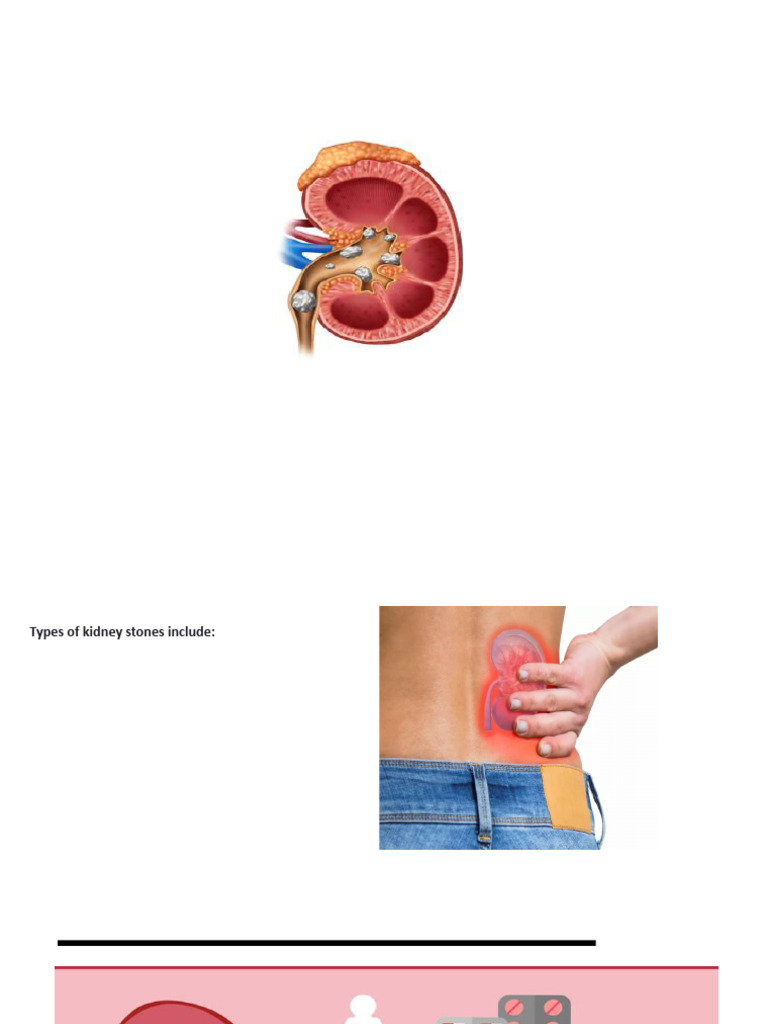 Kidney Stones CDTP Batch 52 | PDF | Medical Specialties | Urology