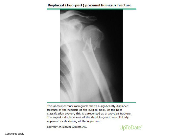 Adult Proximal Humerus Fracture 2 | PDF