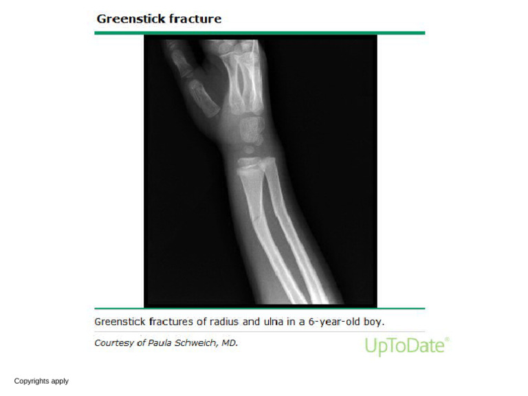 Greenstick Fracture | PDF