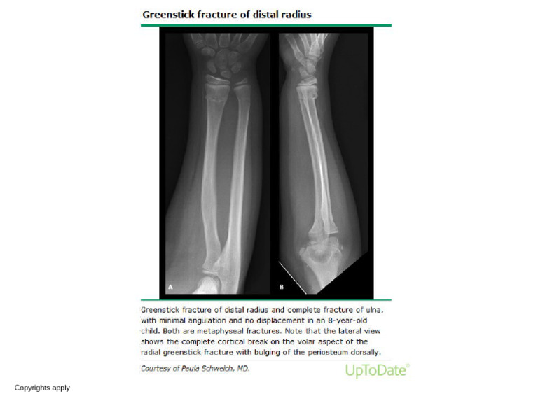 Greenstick Fracture Radius | PDF