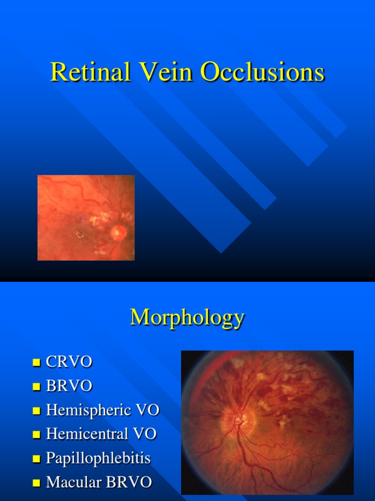 Rvo | PDF | Glaucoma | Retina