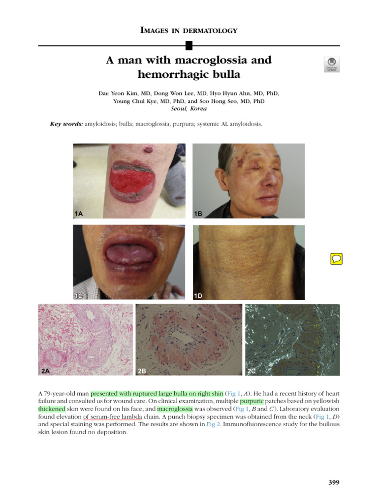 A Man With Macroglossia and Hemorrhagic Bulla | PDF | Diseases And ...