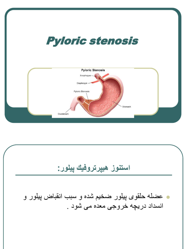 Stenosis Pyloric | PDF