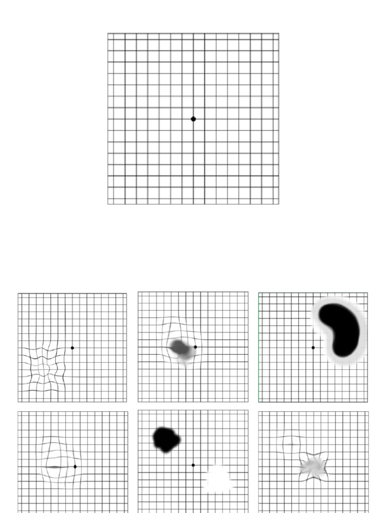 Eye Check - Macular Degeneration | PDF