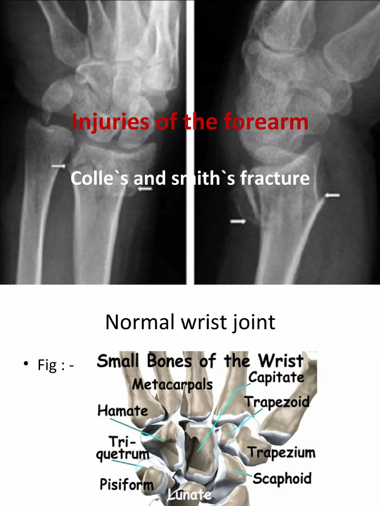 Colle s and Smith s Fracture Ppt 2 | PDF