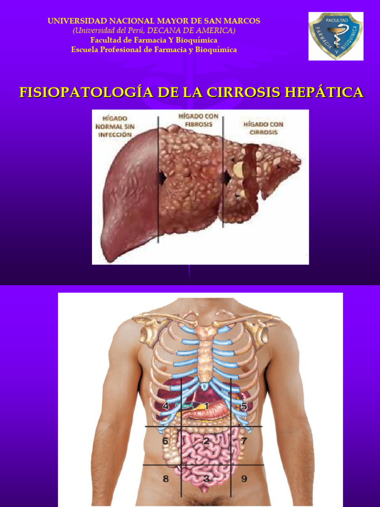 Fisiopatologia de La Cirrosi Hepatica 2024 | PDF | Cirrosis | Hígado